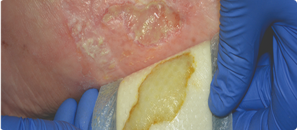 Wie Wunden heilen| Coloplast Wundversorgung